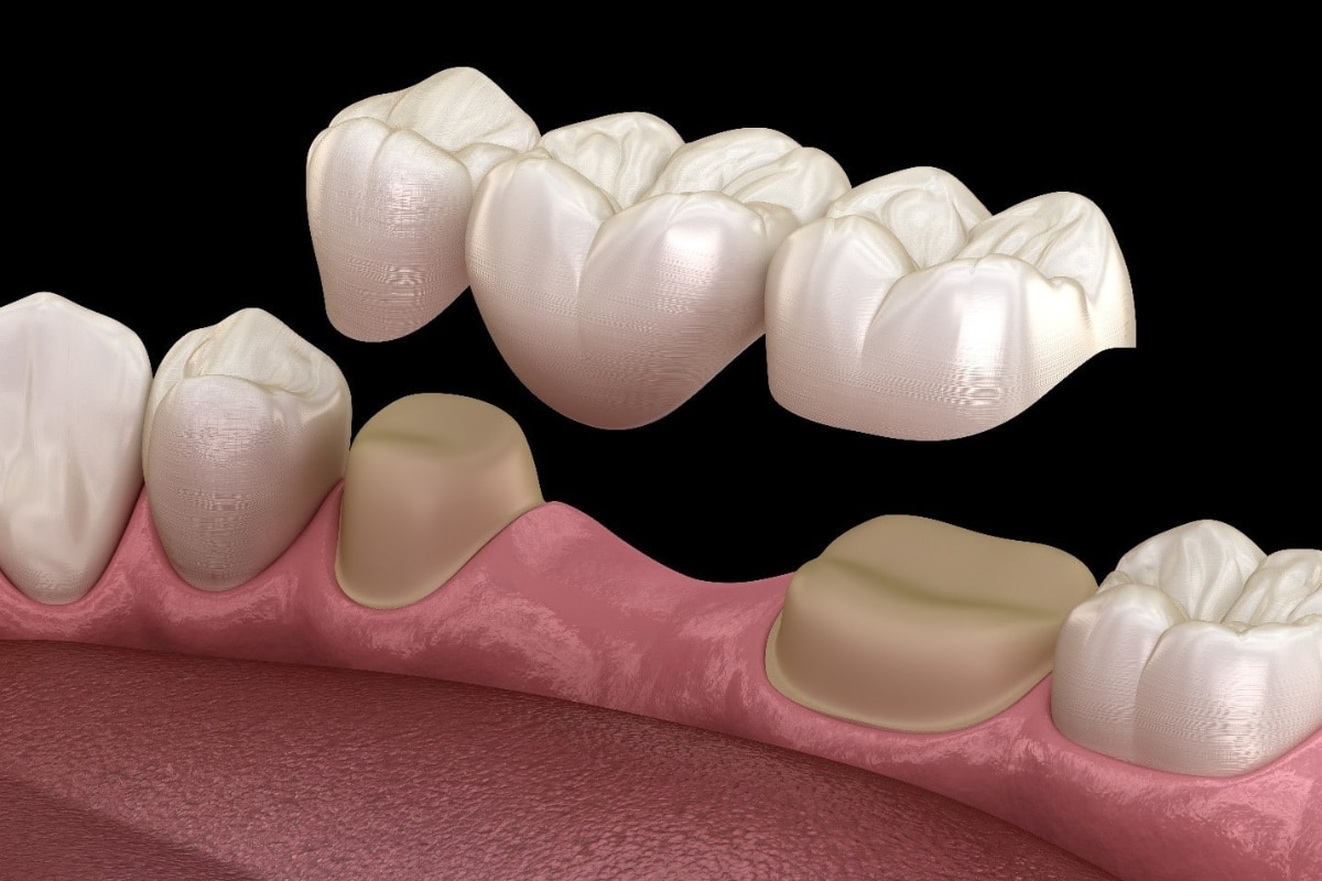 What to Expect When Getting a Dental Bridge for a Back Molar